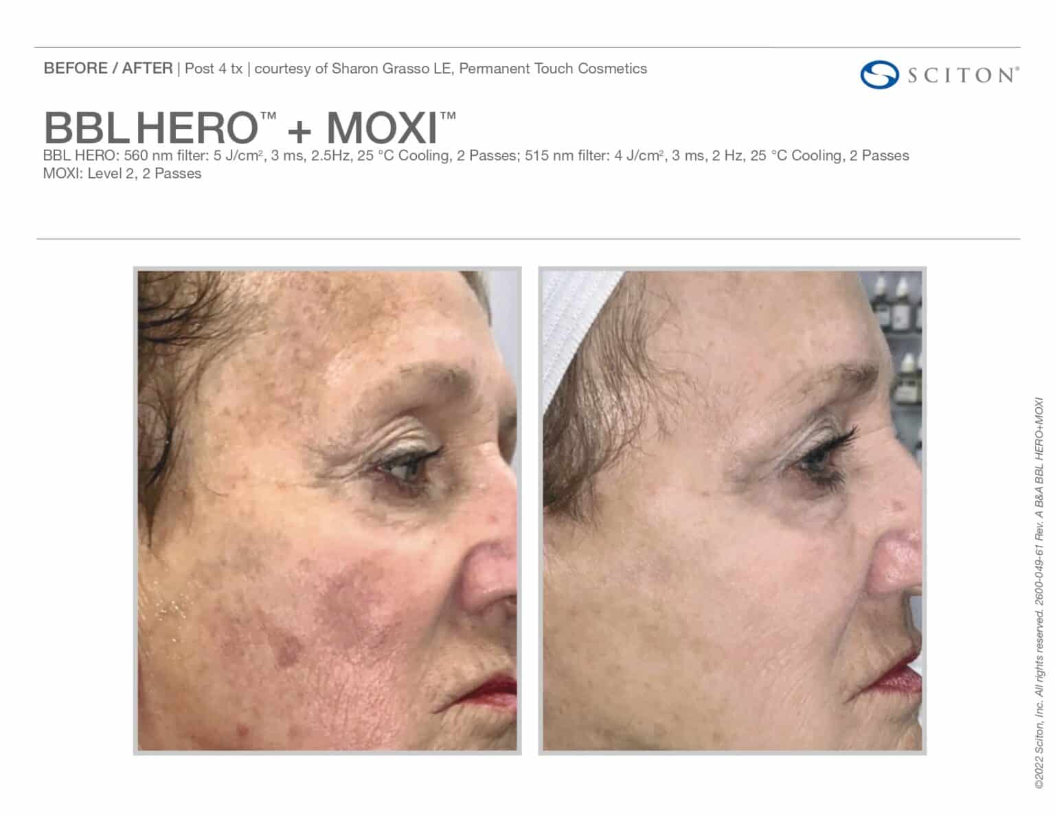 Moxi Laser Treatment Denver CO - Laser Treatment Denver