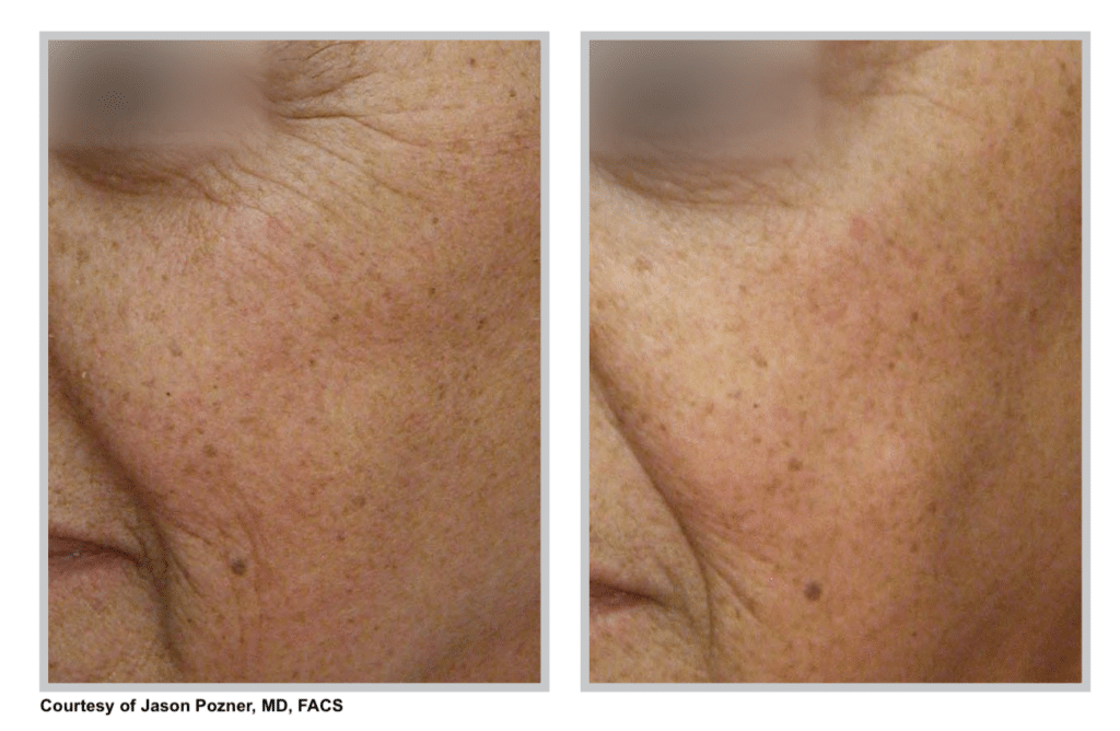 Arctic Laser Peel Denver CO - Skin Rejuvenation Treatment CO